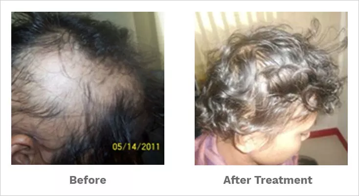 Does Homeopathy Work for Hair Loss? | Dr Batra's® Does Homeopathy Work for Hair Loss? | Dr Batra's®