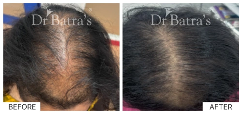 Female Pattern Baldness Homeopathy Treatment | Dr Batra’s®