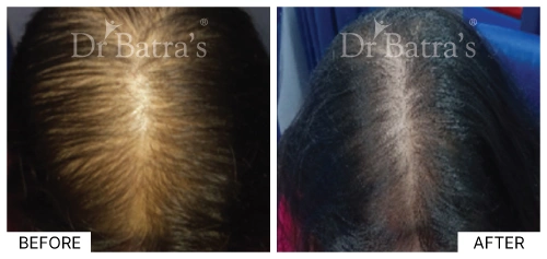 Symptoms & Stages of Female Pattern Baldness | Dr Batra's®