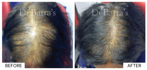 Symptoms & Stages of Female Pattern Baldness | Dr Batra's®