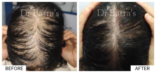 Symptoms & Stages of Female Pattern Baldness | Dr Batra's®