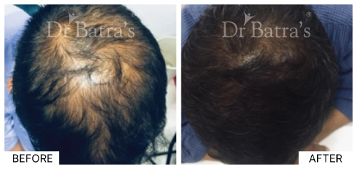 Male Pattern Baldness Symptoms & Hair Loss Stages | Dr Batra’s®