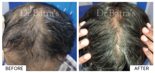 Male Pattern Baldness Symptoms & Hair Loss Stages | Dr Batra’s®
