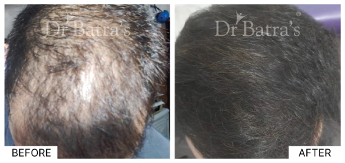 Male Pattern Baldness Symptoms & Hair Loss Stages | Dr Batra’s®