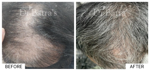 Male Pattern Baldness Symptoms & Hair Loss Stages | Dr Batra’s®