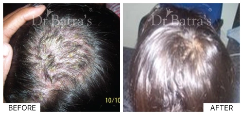 Seborrhoeic Dermatitis:Types, Causes & Treatment|Dr Batra's™