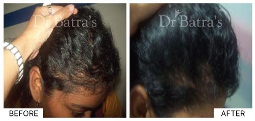 Trichotillomania Overview | Dr Batra’s®