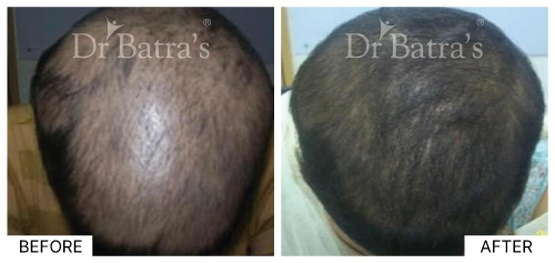 Trichotillomania Overview | Dr Batra’s®