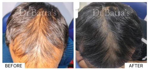 Homeopathy Treatment for Hair Loss & Solution | Dr Batra’s®