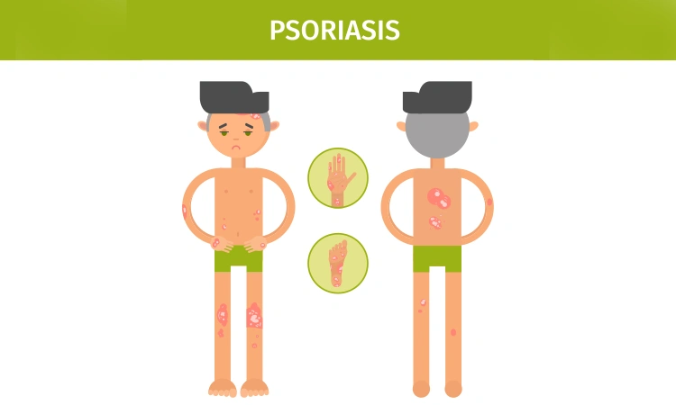 Is Psoriasis An Autoimmune Disease? - Dr. Batra’s® Homeopathy