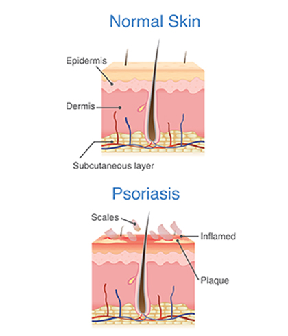 Scalp Psoriasis In Children - Dr. Batra’s® Homeopathy