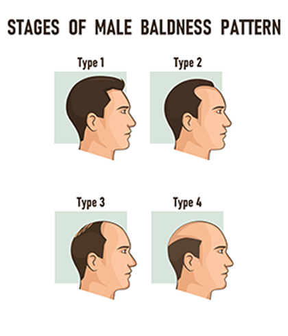 What is the best hair fall treatment for men? | Dr Batra’s™