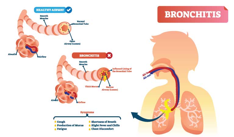 Chronic bronchitis in elderly: Causes and prevention | Dr Batra’s™