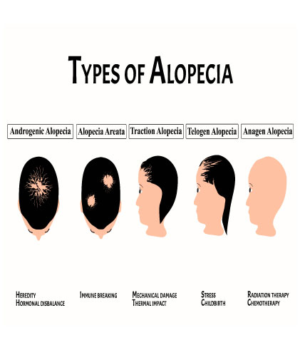 Types of Alopecia | Dr Batra’s™
