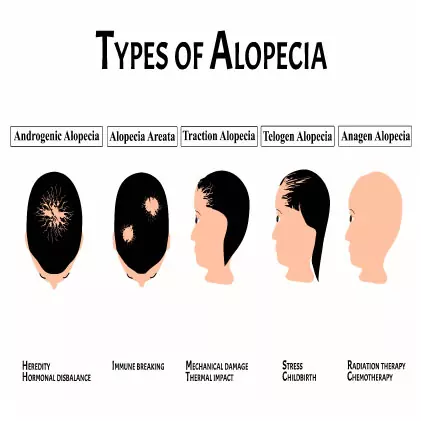Types of Alopecia | Dr Batra’s™