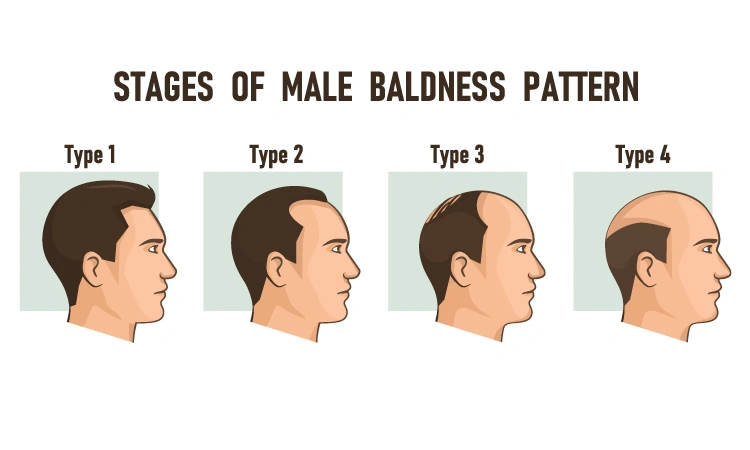What is the best hair fall treatment for men? | Dr Batra’s®