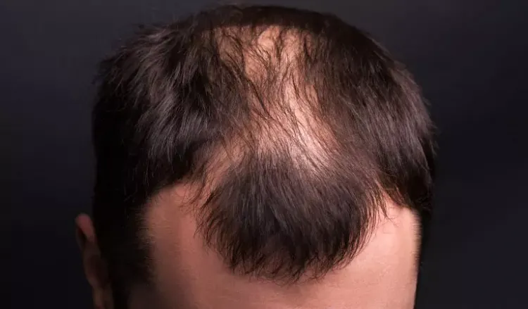 Hair fall control tips | Dr Batra’s®