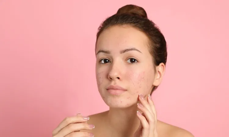 Acne vs. Pimples | Dr Batra’s®