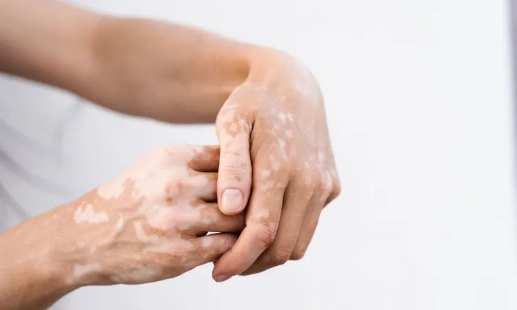 Know the early signs of vitiligo | Dr Batra’s®