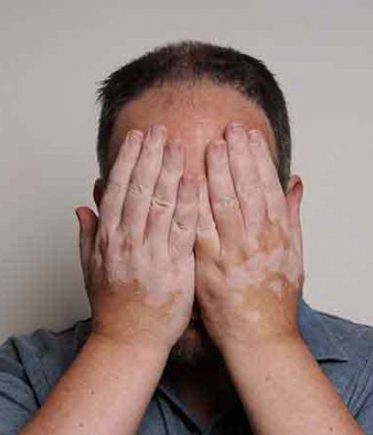 How to identify White Patches on Skin or Vitiligo disease