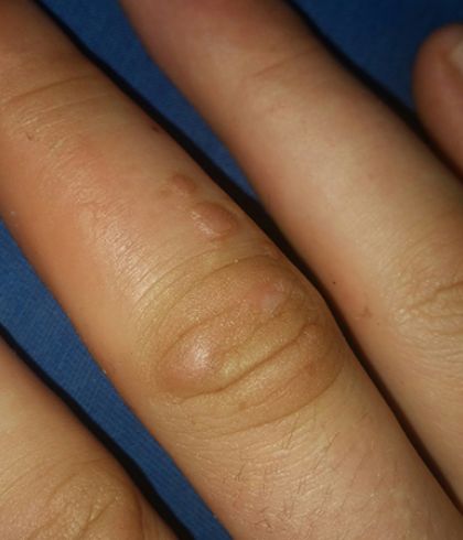 Different types of warts | Dr Batra’s™