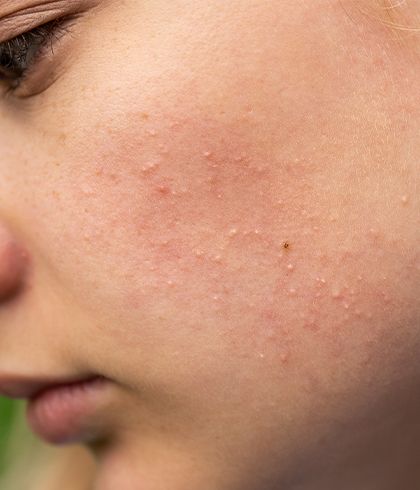 10 Most Common Skin Disorders - Dr. Batra’s®