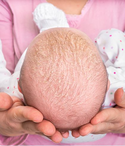 Scalp Psoriasis In Children - Dr. Batra’s® Homeopathy