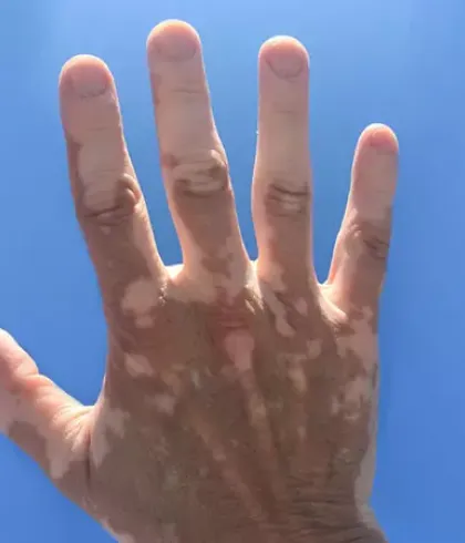 5 things to know about vitiligo disease | Dr Batra’s™