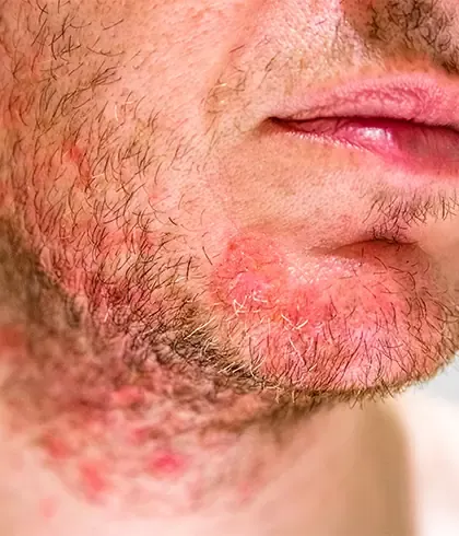 Seborrheic Dermatitis Vs. Atopic Dermatitis - Dr. Batra’s®