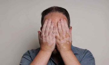 How to identify White Patches on Skin or Vitiligo disease