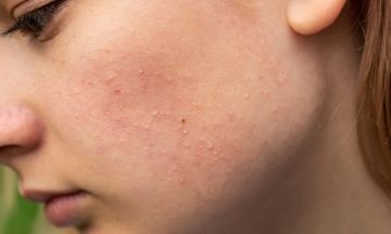 10 Most Common Skin Disorders - Dr. Batra’s®